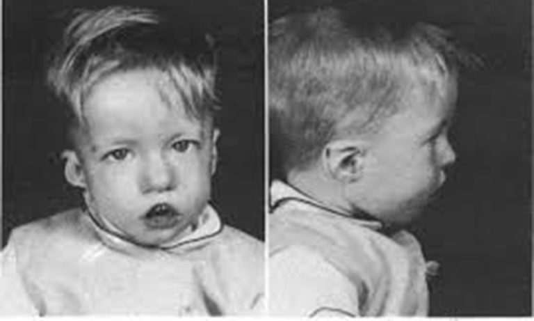 ¿Sabes qué es el síndrome de DiGeorge? – Frontal Noticias