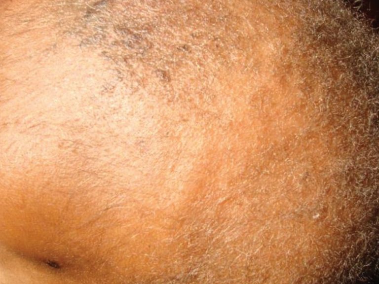 Conoce en qué consiste la enfermedad de Menkes – Frontal Noticias